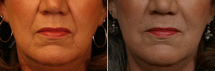 Picerno_Denver-Lone-Tree_Injectable-Fillers-(Perioral)-3-AP ...